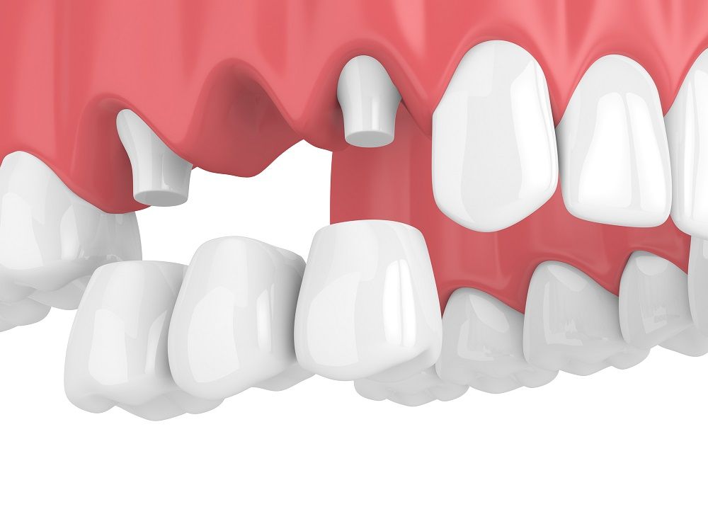Choosing Dental Bridges For Missing Teeth - Owings Mills Dentist